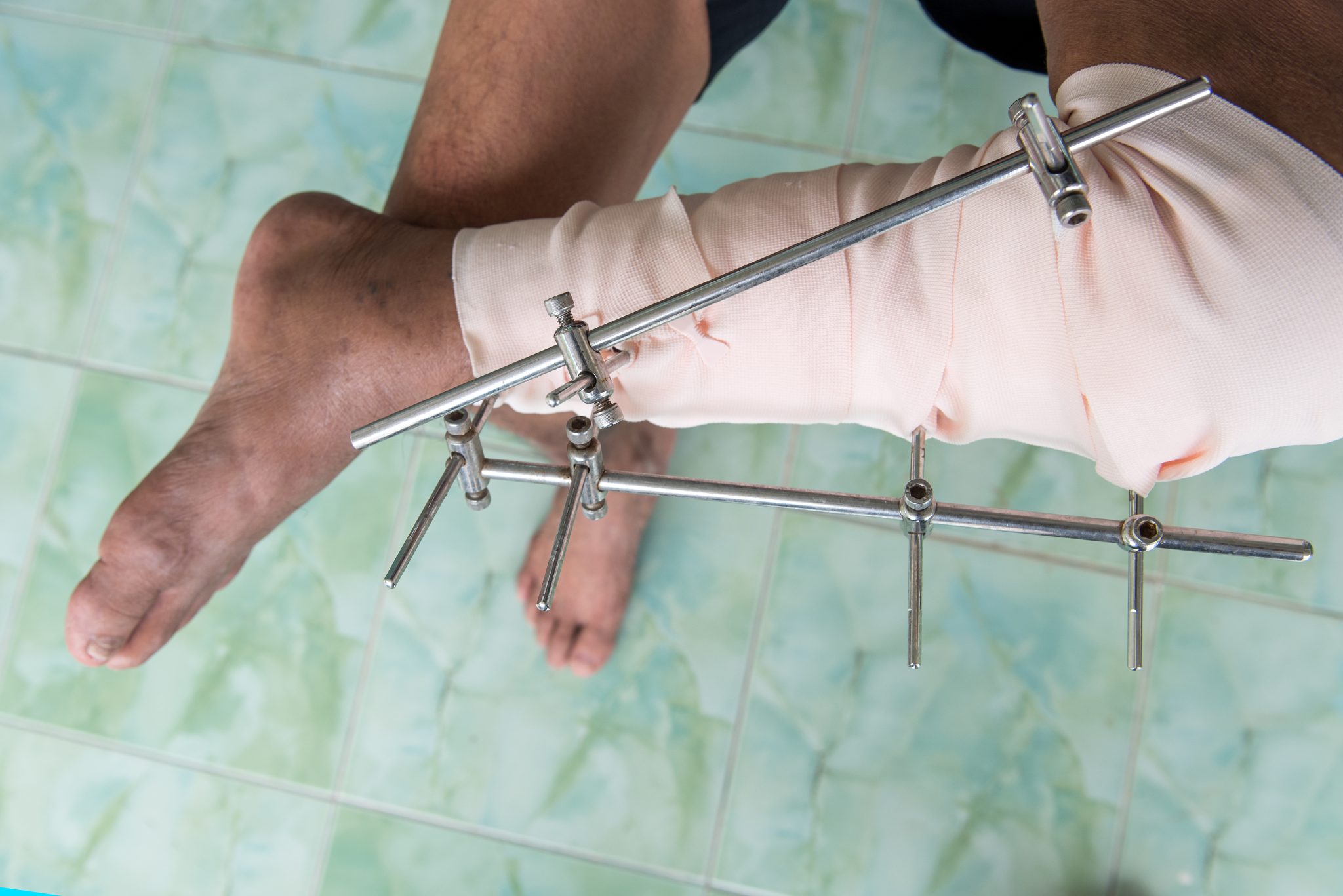 Metal Rod in Leg Surgery: Benefits, Risks & Recovery